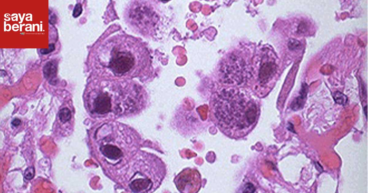 Cytomegalovirus Itu Apa, Sih? - Saya Berani
